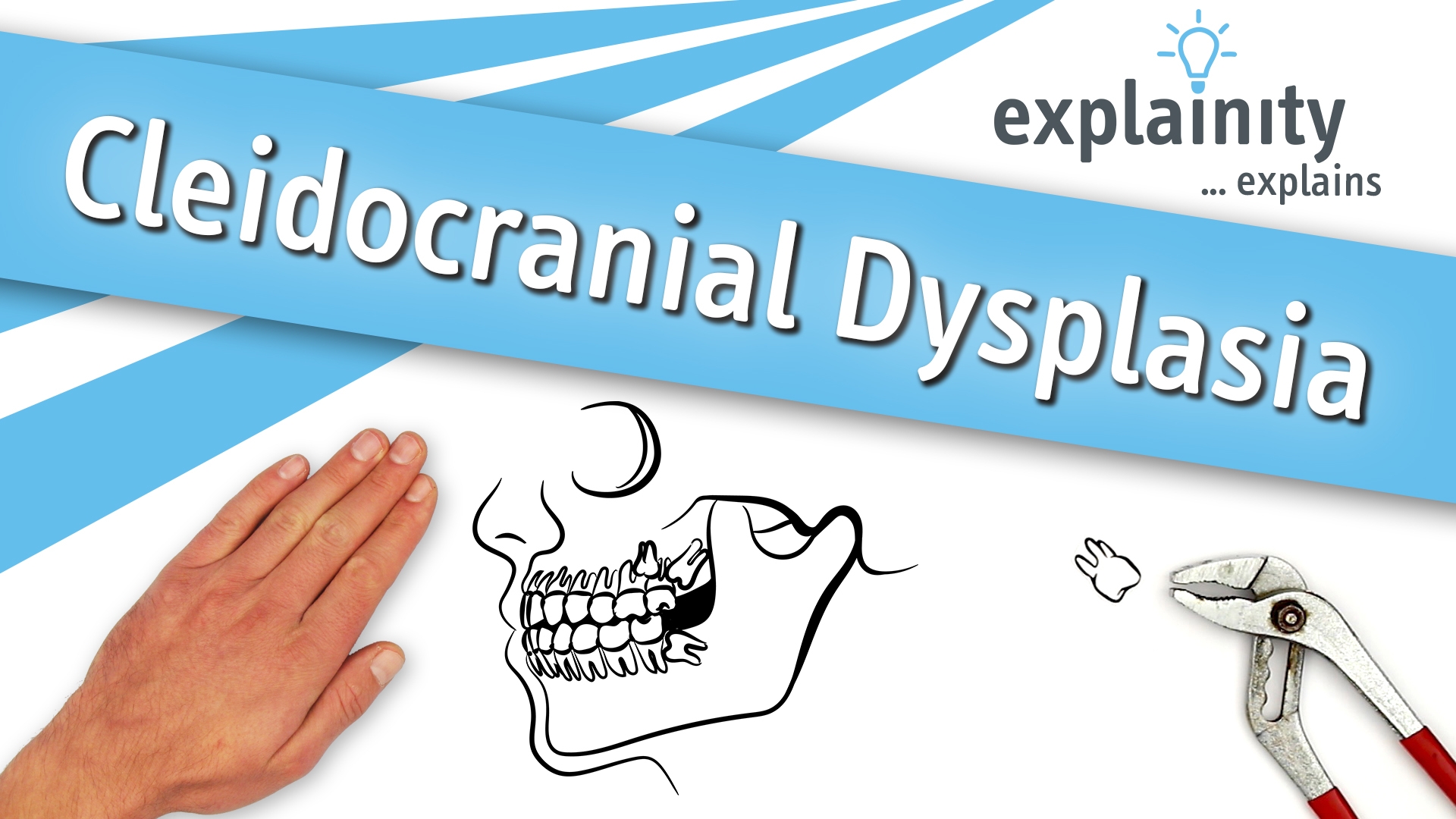 Explanation video Cleidocranial Dysplasia explained