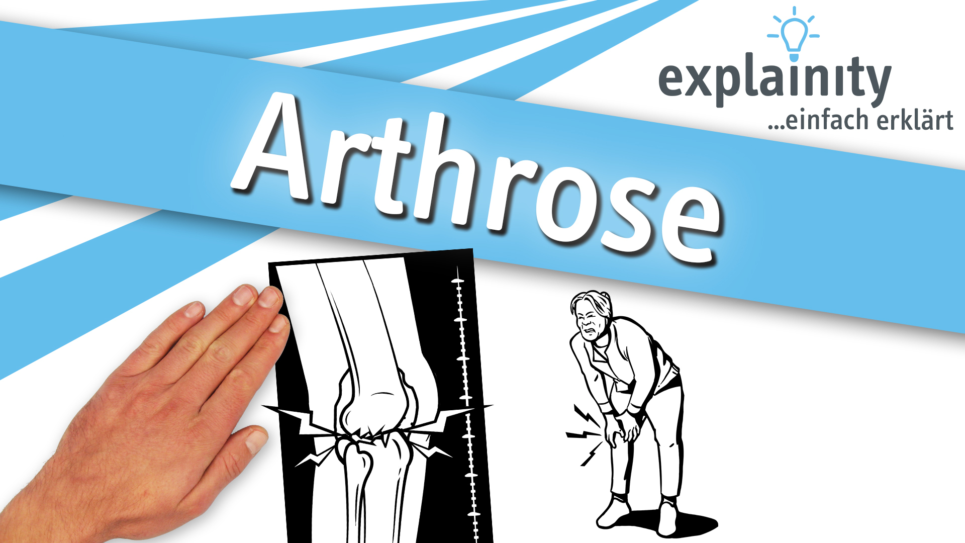 Arthrose - einfach erklärt